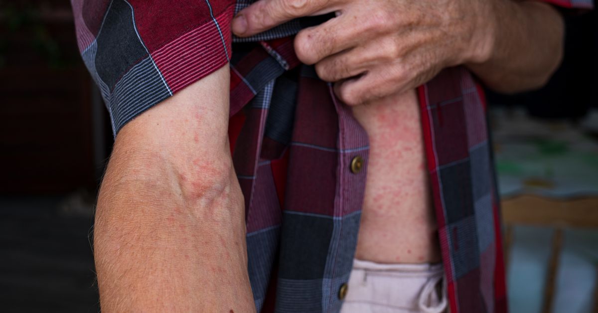 Hives: How Long Do They Last?