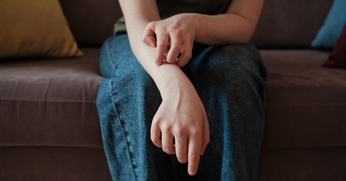 Urticarial Vasculitis: Symptoms, Causes, Treatment, and More