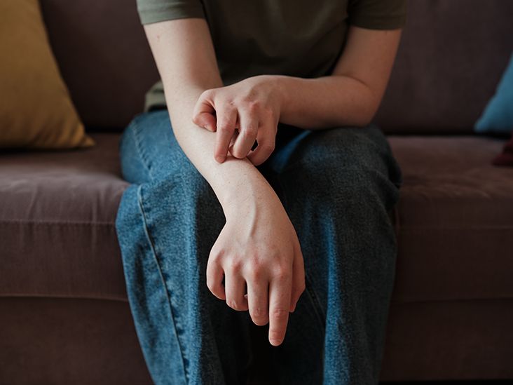 Urticarial Vasculitis: Symptoms, Causes, Treatment, and More