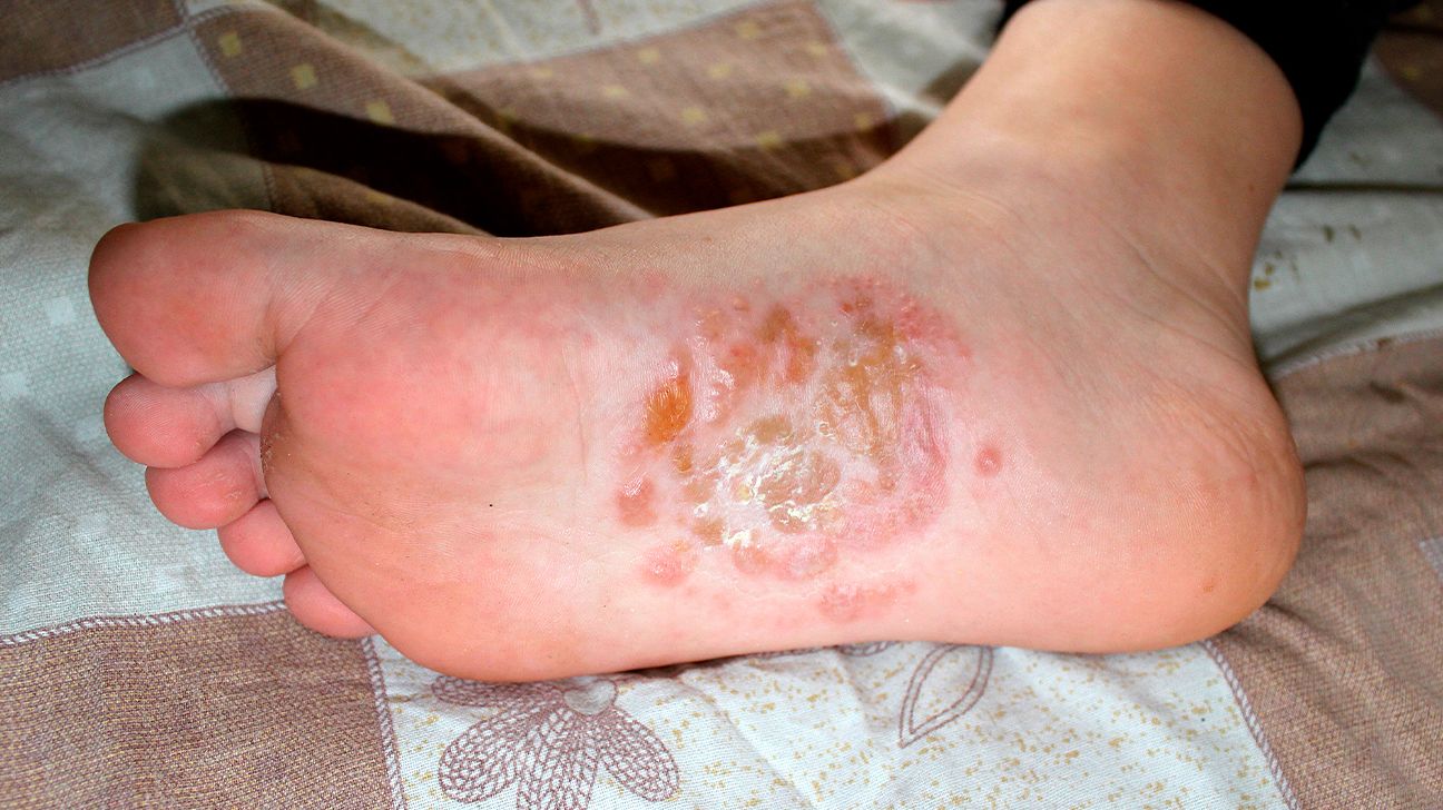 Fungus Blisters On Feet What Is The Difference Between A Blister And A