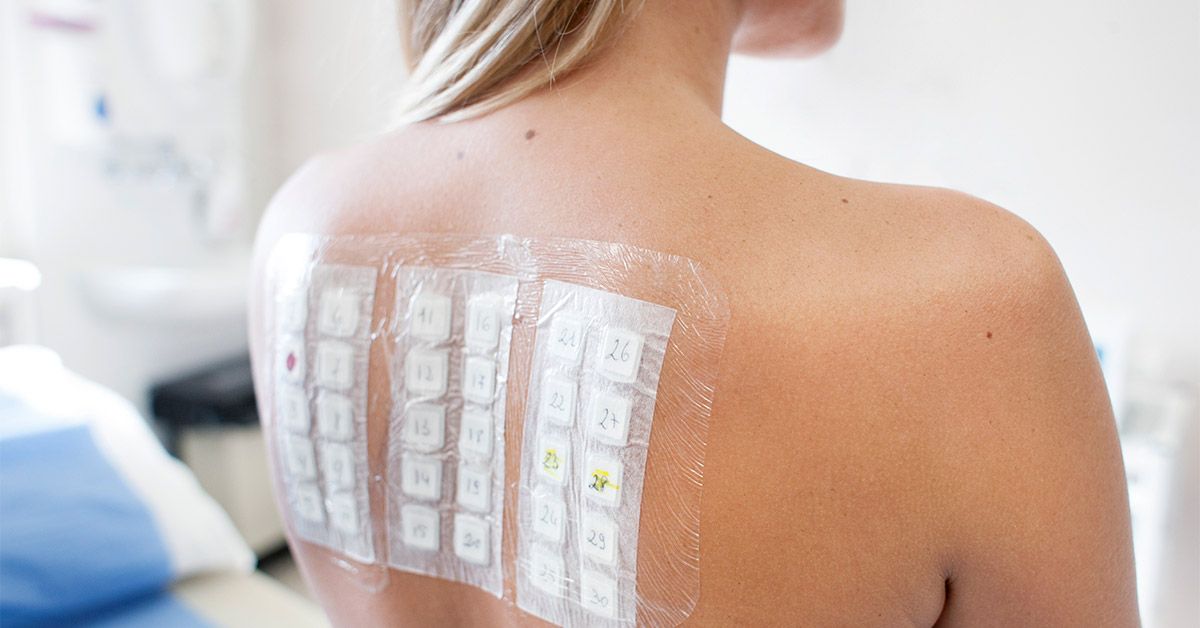 Food Allergy Tests for Ulcerative Colitis: What to Know