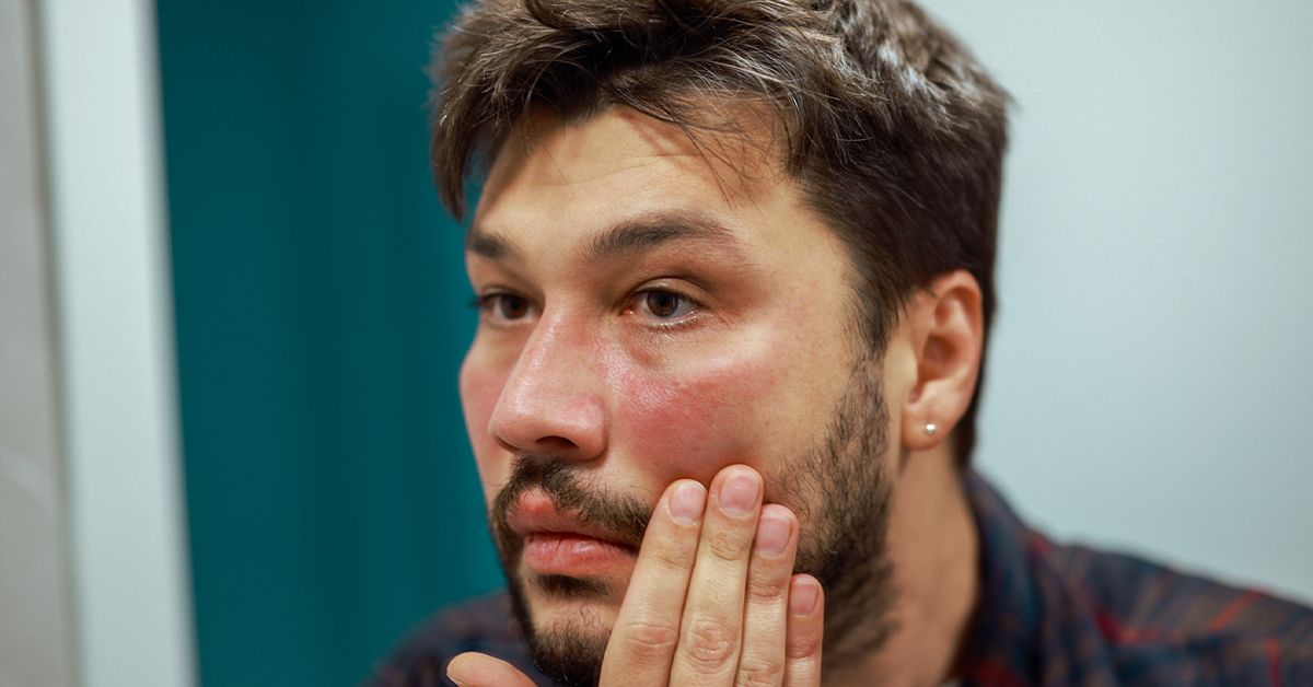 Prostate Cancer and Skin Rash: Is It a Symptom or Side Effect?