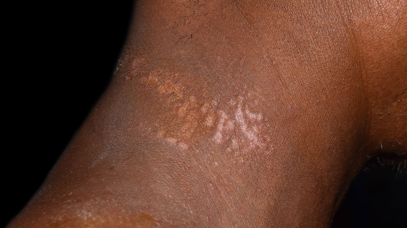 Tinea Versicolor On Face
