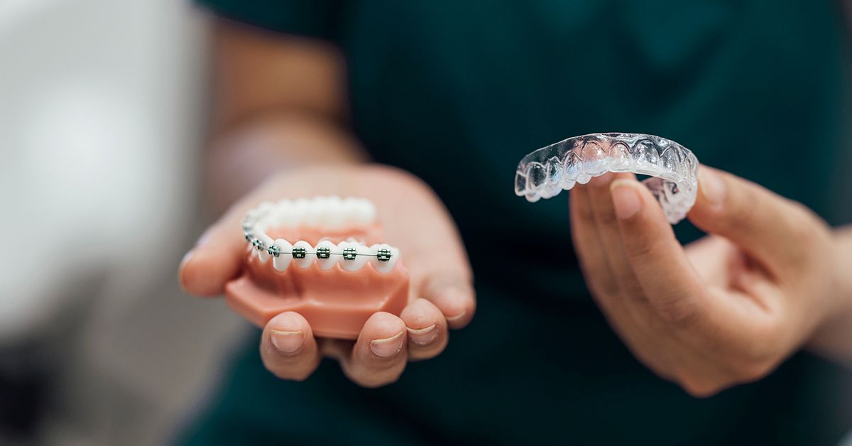 Aligners vs. Braces: What to Choose?
