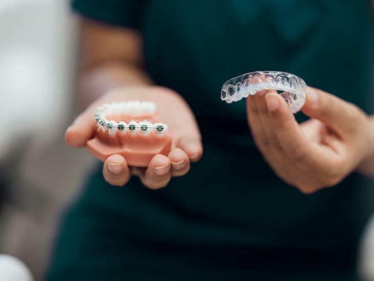 Aligners vs. Braces: What to Choose?