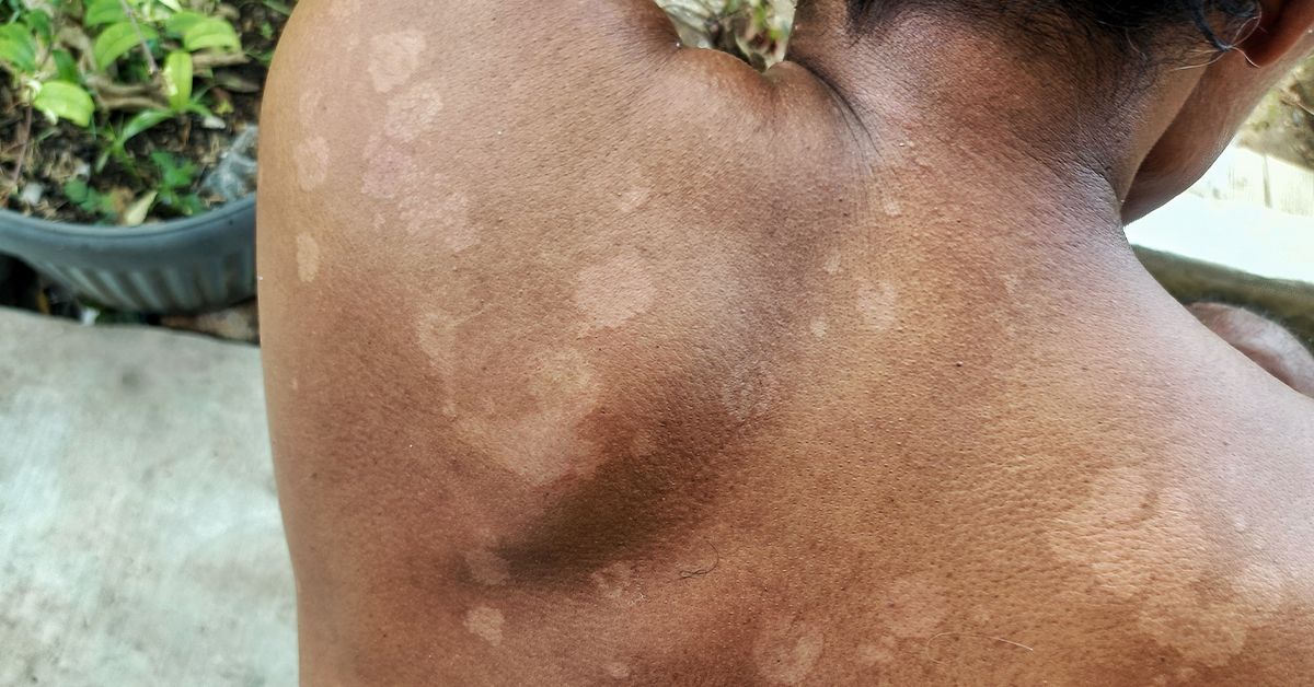 Tinea Versicolor Arms