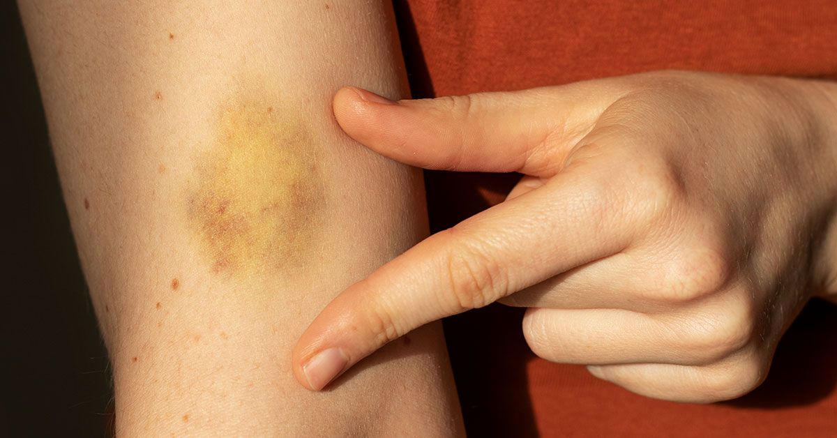 Is Easy Bruising a Symptom of Hyperthyroidism?
