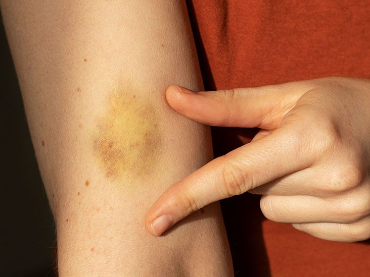 Is Easy Bruising a Symptom of Hyperthyroidism?