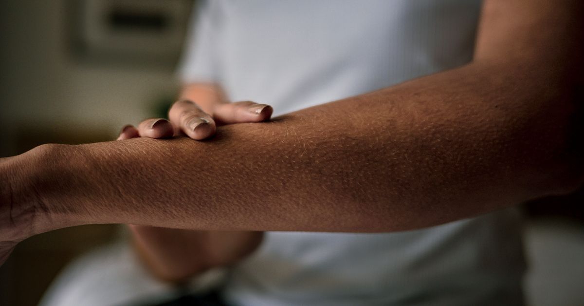Formication: What You Need to Know About This Skin Crawling Sensation