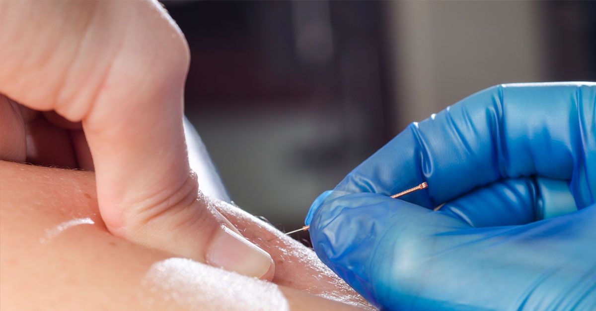 Medicare and dry needling: Coverage and more
