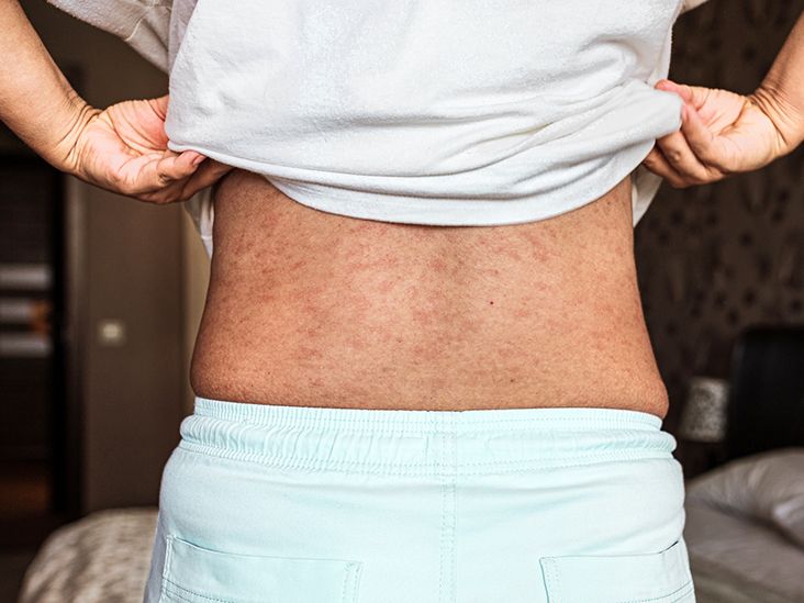 What Is Subacute Cutaneous Lupus (SCLE)?