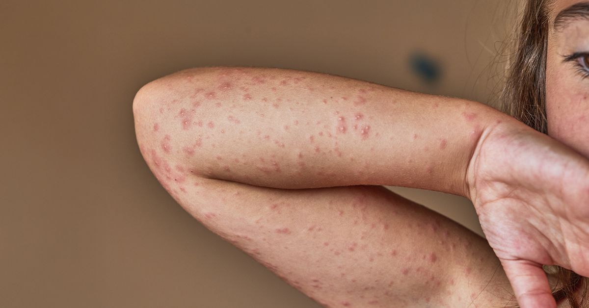 Amoxicillin Rash: How to Identify and Treat