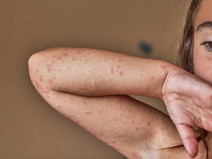 Amoxicillin Rash: How to Identify and Treat