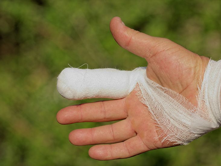 Ring Avulsion Injury: Causes, Prevention, and More