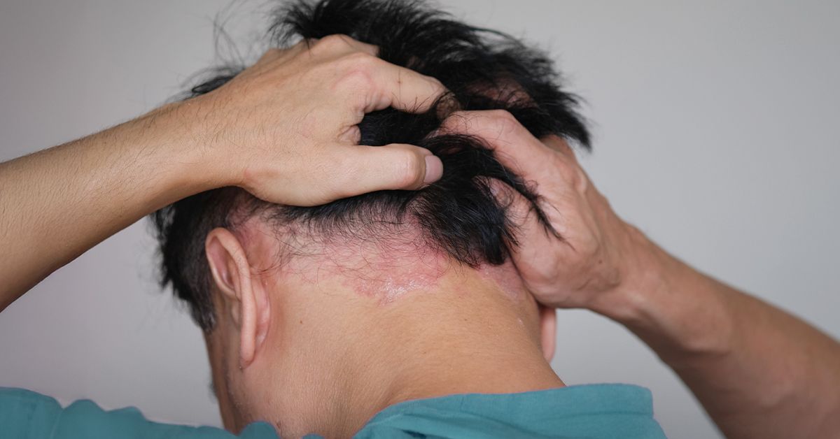 Scalp Psoriasis Medications: Over the Counter and Prescription
