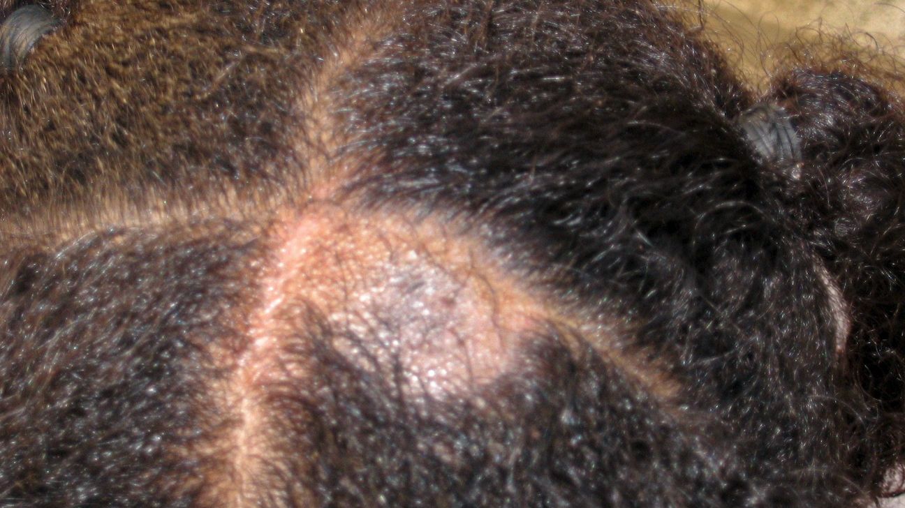 What Are The Brown Spots On My Bald Head - Infoupdate.org