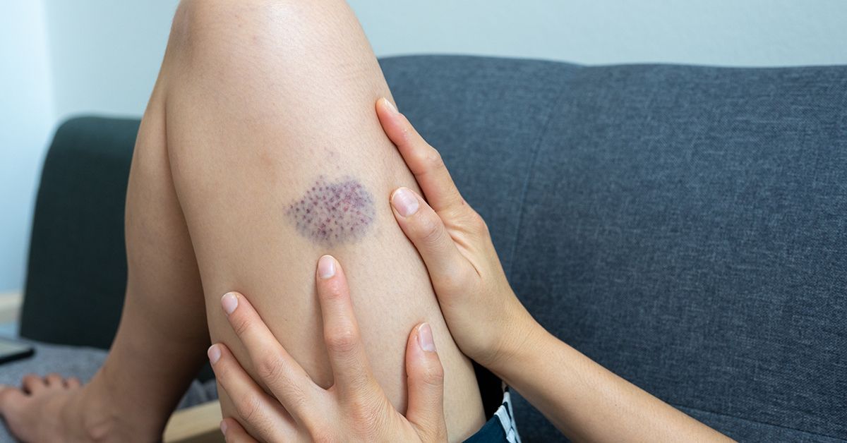 Hematoma vs. Bruise: What Is the Difference?