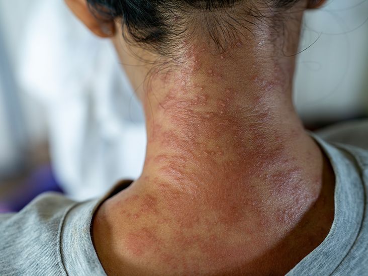 Hashimoto's Rash: Causes, Symptoms, and Treatment