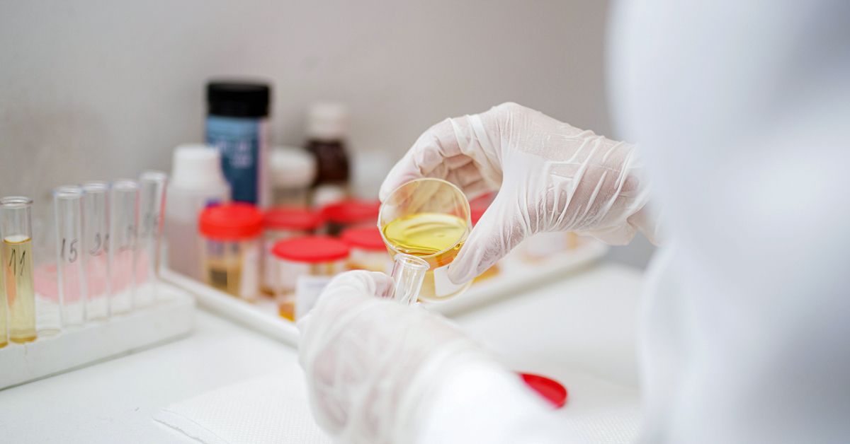 Bilirubin in Urine (Bilirubinuria): Symptoms, Causes, Treatment