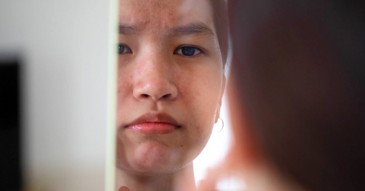 Angioedema Lips: What It Looks Like, Causes, and More