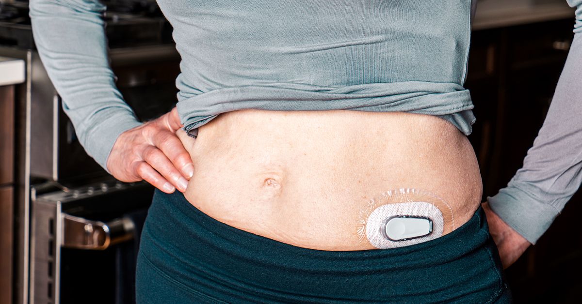 What's a CGM (Continuous Glucose Monitor) and Picking One