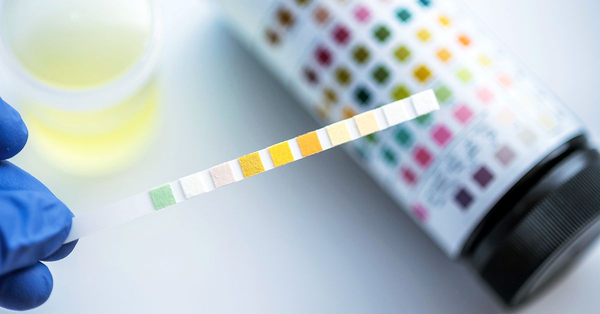 Urine Protein Creatinine Ratio Test: Levels, Results, What to Expect