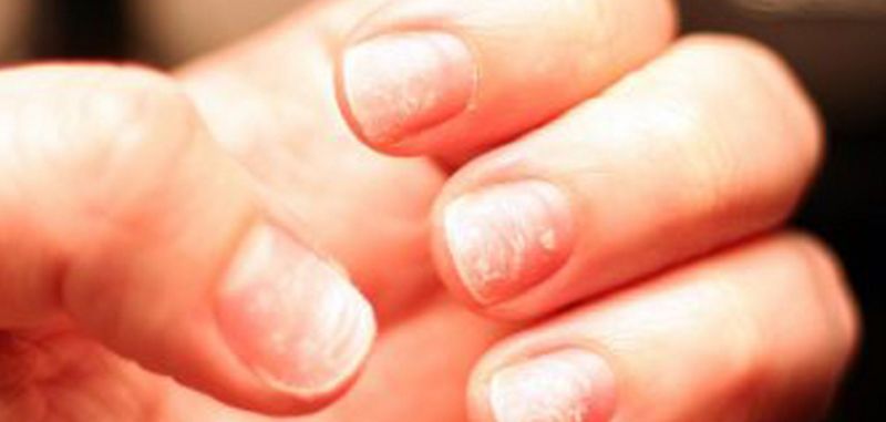 Rough Dry Fingernails
