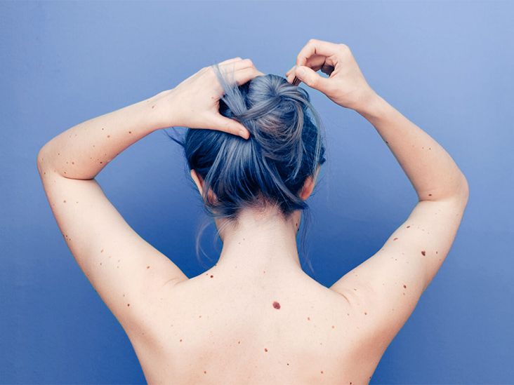 No Sun? You Should Still Get Those Moles Checked