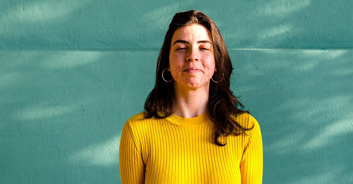 Adult Acne in Your 20s and 30s: Causes, Treatments, Home Remedies