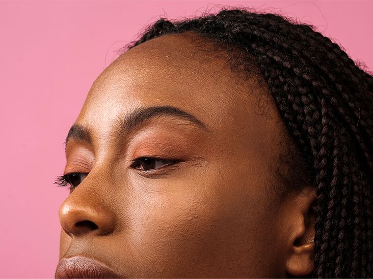 Pimples on Hairline: Causes, Treatment, and Prevention