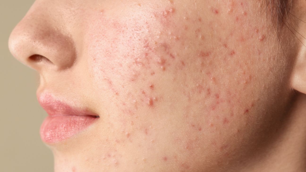 Moderate To Severe Acne