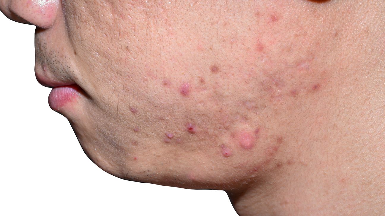 Moderate Acne