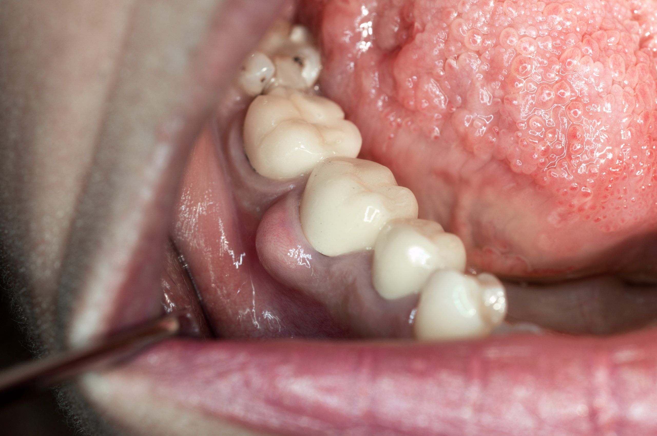 Giant Abscess In Mouth