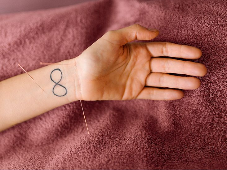 Is Acupuncture Safe? Risks, Benefits and What to Expect