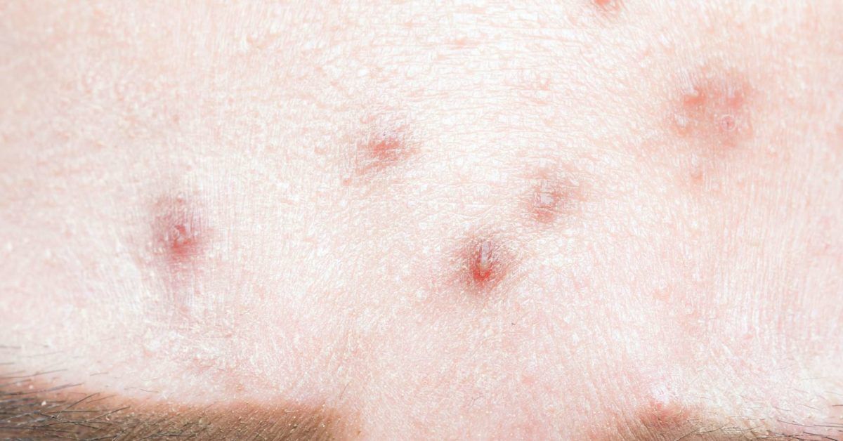 Bump on forehead: 7 causes and treatment