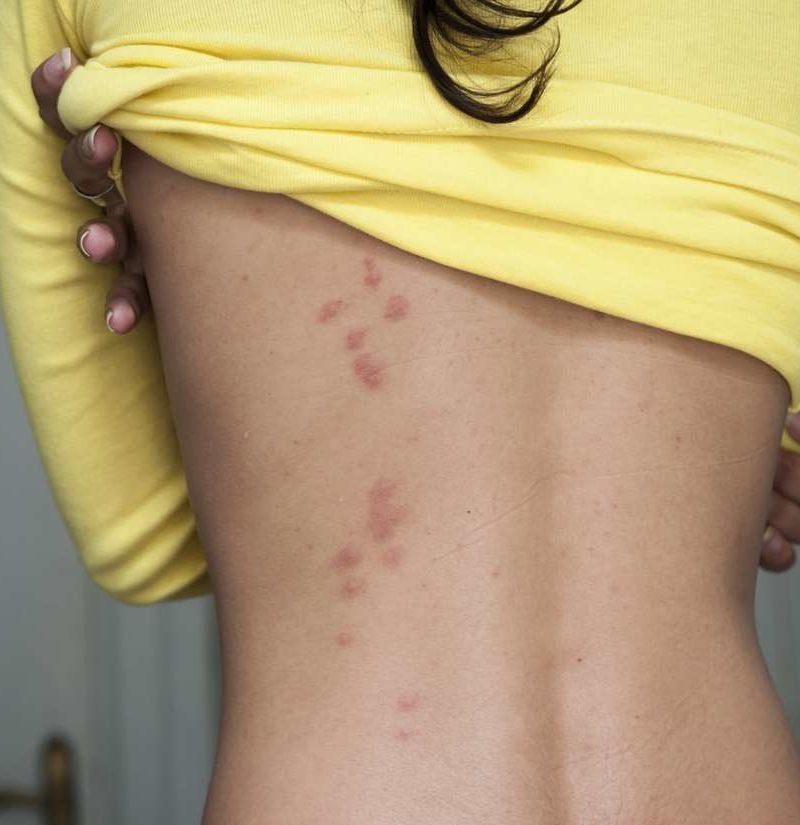 Picaduras de chinches de cama: Fotos, tratamiento y prevención