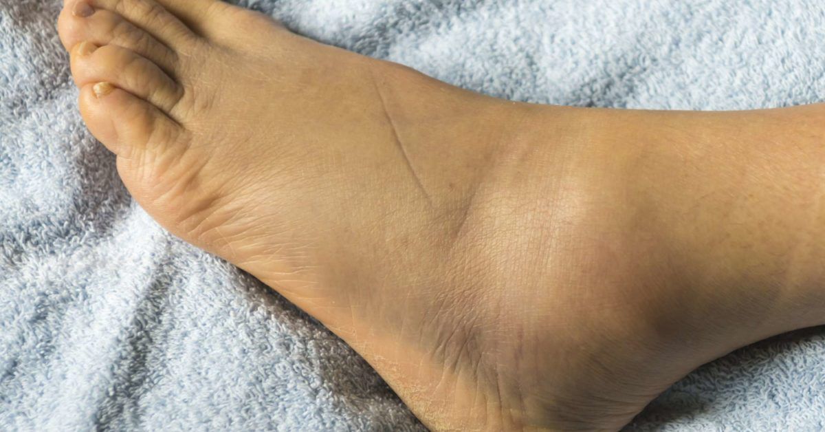 Pies hinchados: 15 causas, tratamientos y remedios caseros