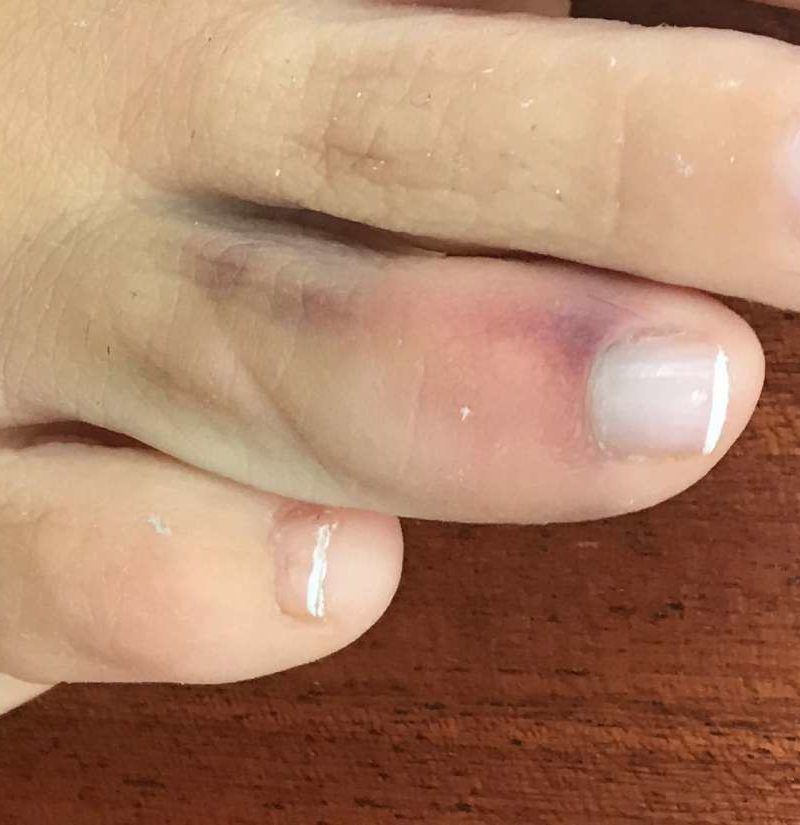 Sprained toe: Symptoms, causes, and treatment