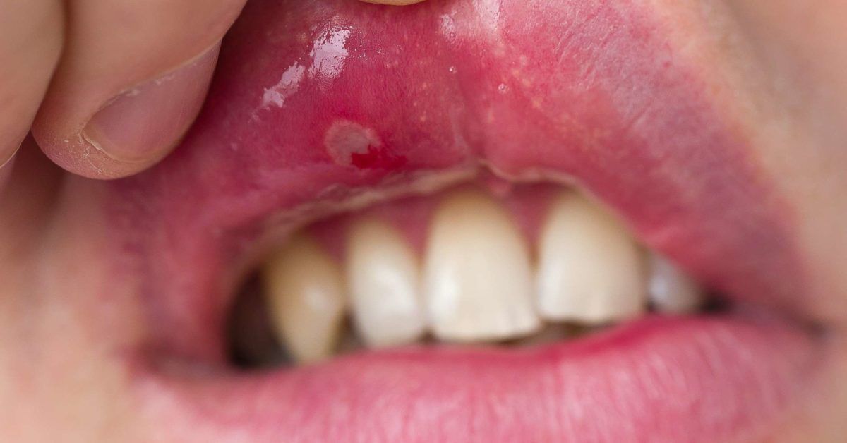 Úlceras bucales: Tipos, causas, síntomas y tratamiento