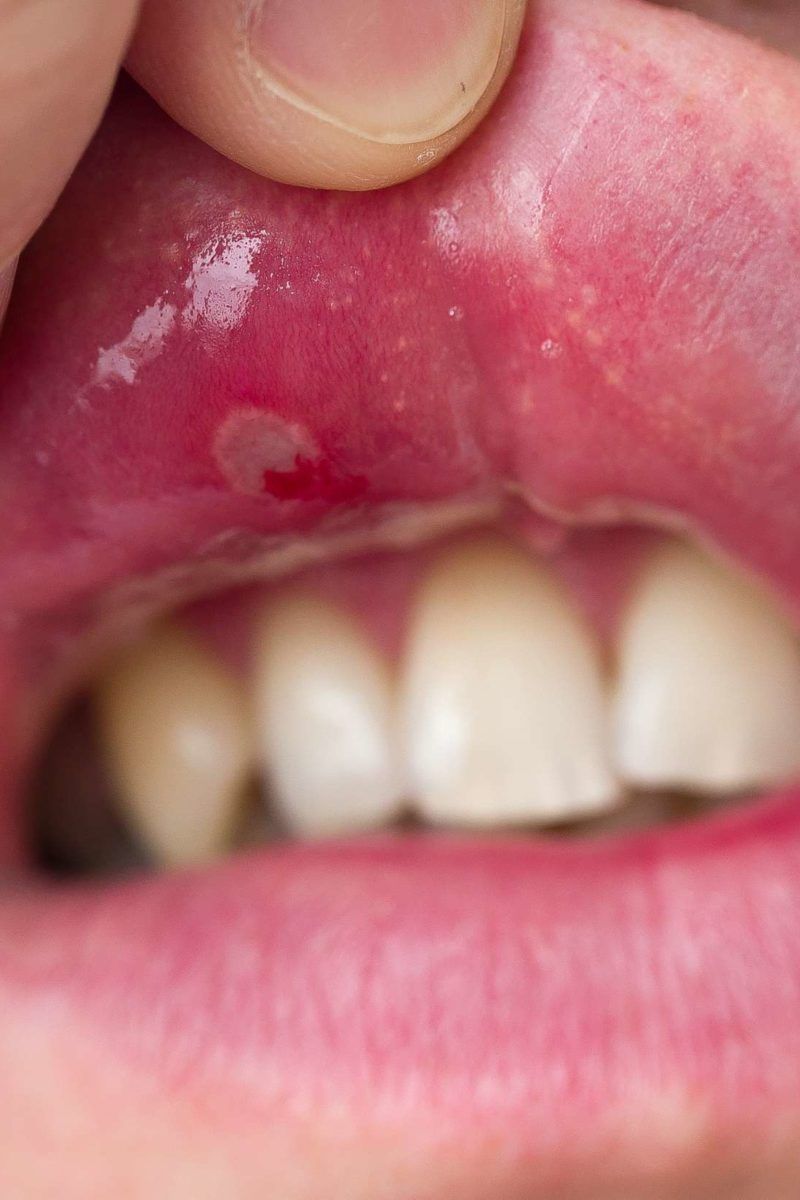 Úlceras bucales: Tipos, causas, síntomas y tratamiento