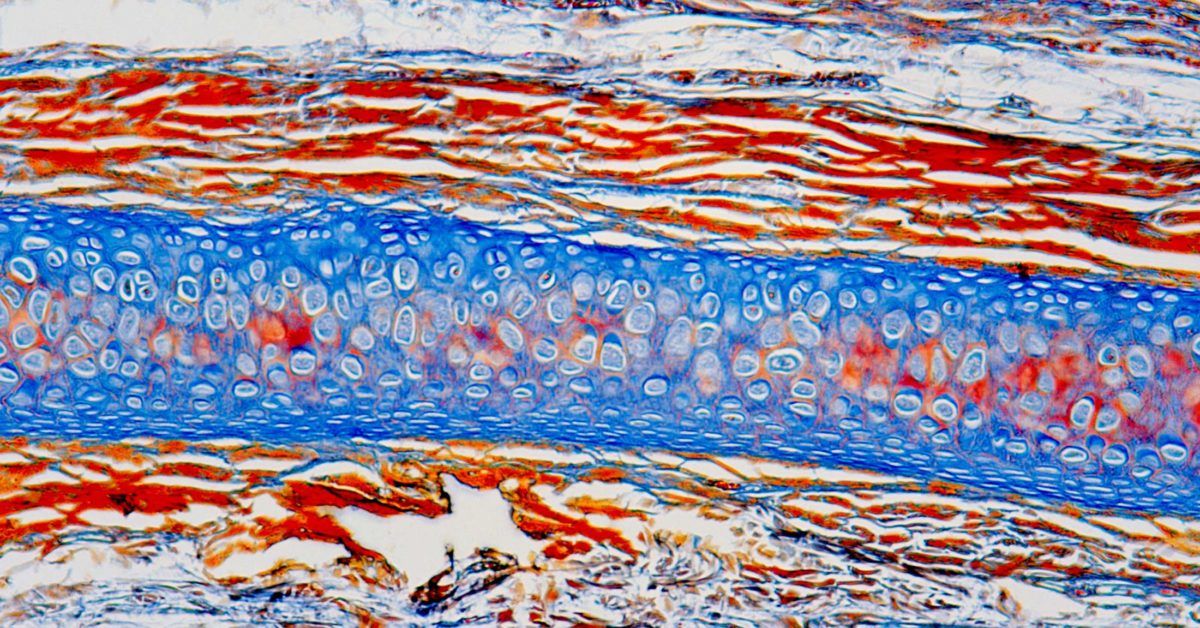 Cartilage damage: Symptoms, causes, diagnosis, and treatment