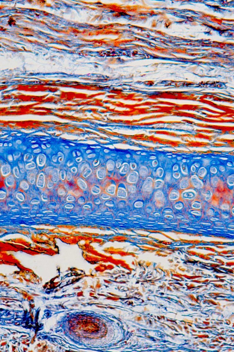 Cartilage damage: Symptoms, causes, diagnosis, and treatment