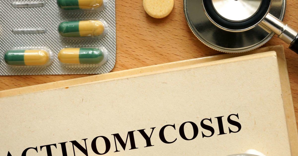 Actinomycosis: Causes, types, symptoms, and diagnosis
