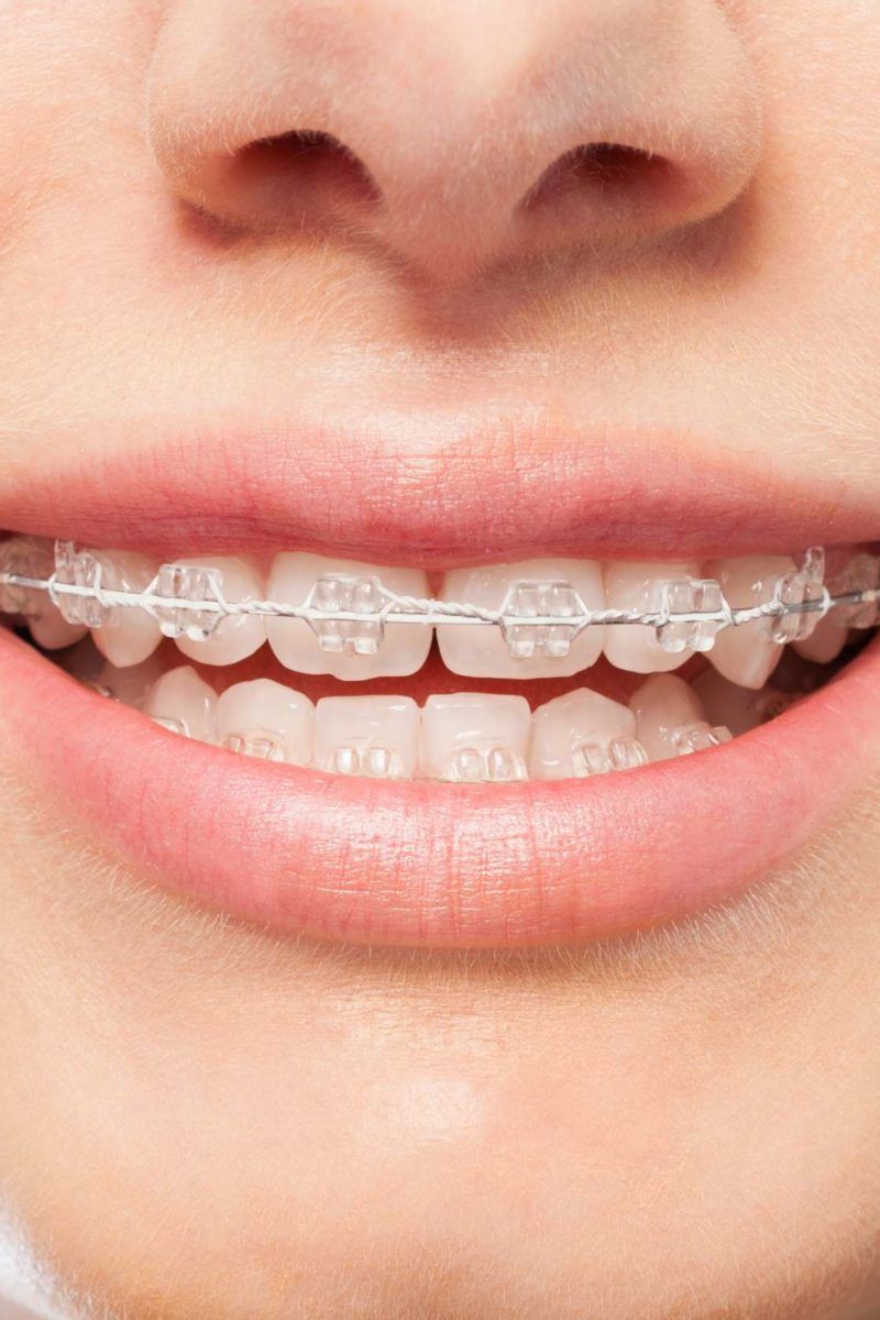 Orthodontics Maloccclusion Other Problems And Starting Treatment