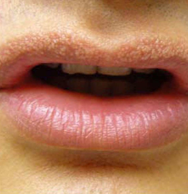 Fordyce Spots Lips Before And After Pictures - Infoupdate.org Fordyce Spots Lips Before And After Pictures - Infoupdate.org