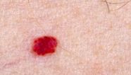 Superficial Hemangioma