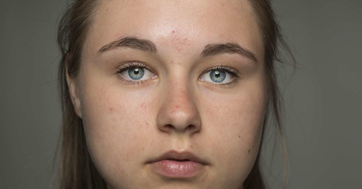 Hormonal acne: Causes and treatment