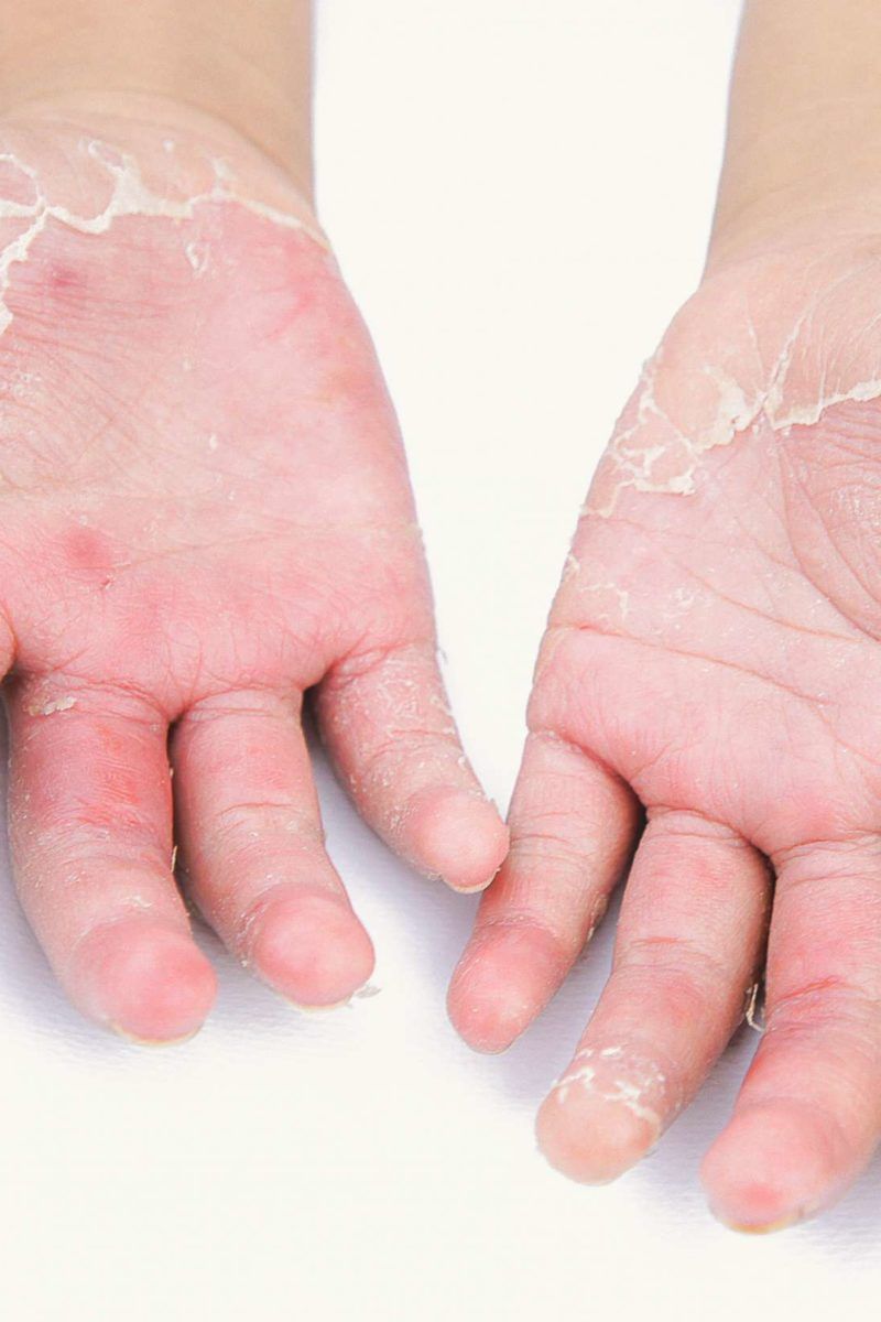 Pies Con Psoriasis Leve