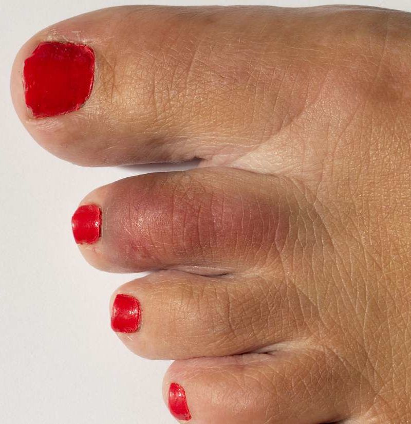 Broken toe: Treatments, symptoms, pictures, and healing time