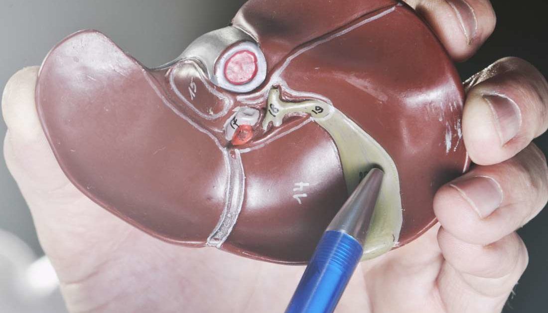 Biliary colic: Symptoms, treatment, and diet